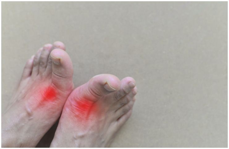 Gout vs Bunion - Your Health Remedy
