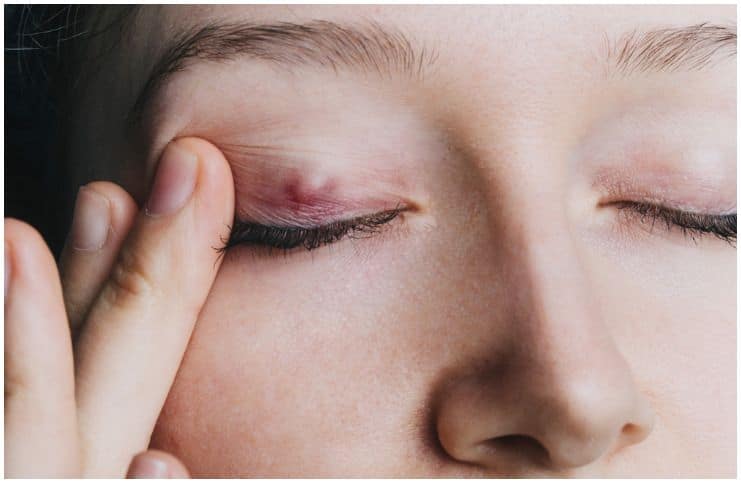 Chalazion vs Stye (Hordeolum) - Your Health Remedy
