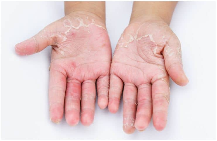 Contact Dermatitis vs Scabies – Differences - Your Health Remedy
