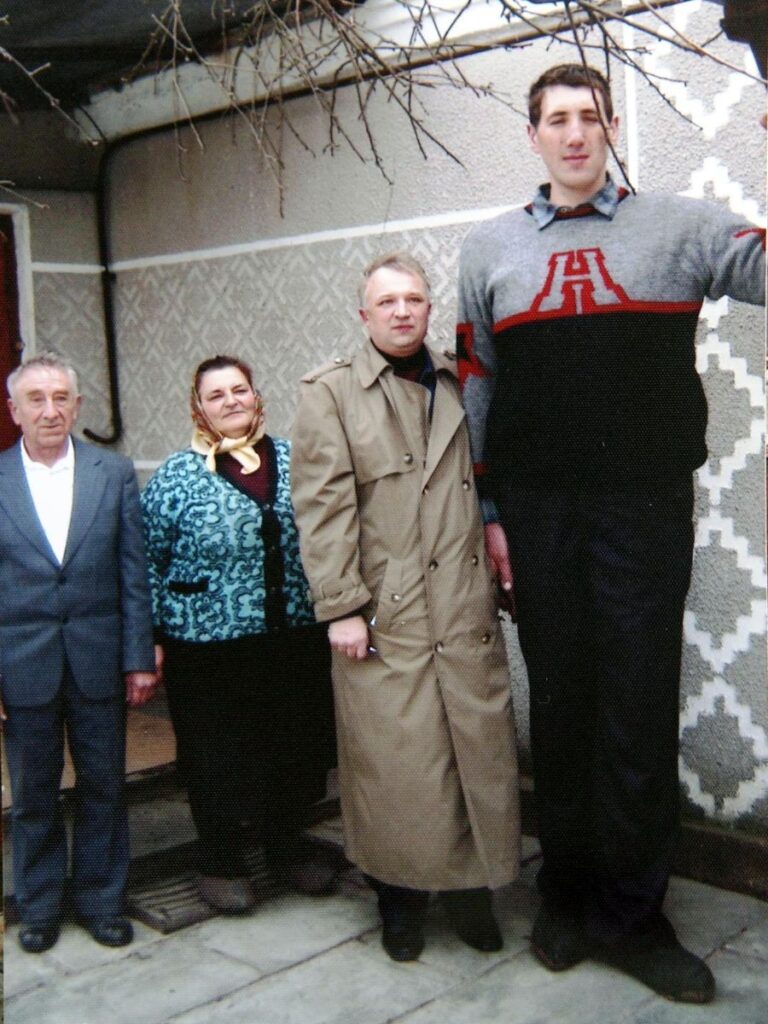 Famous People With Gigantism or Acromegaly - Your Health Remedy