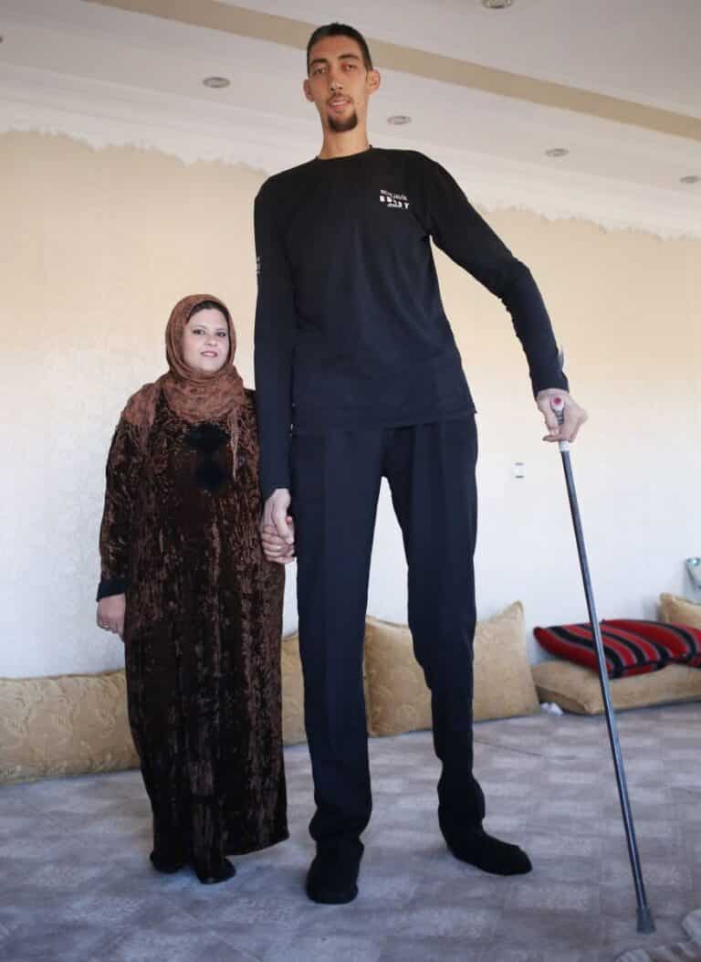 Famous People With Gigantism or Acromegaly - Your Health Remedy